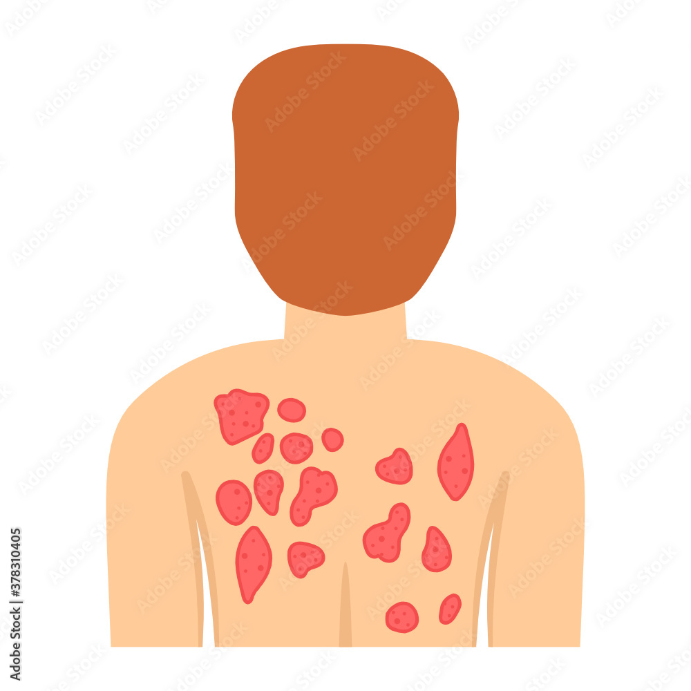 Editable design of body rashes flat style Stock Vector | Adobe Stock