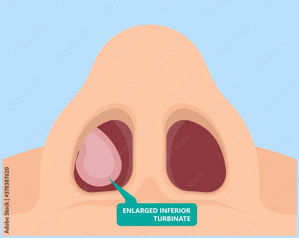 Turbinate hypertrophy ear ENT CPAP nose stop apnea block laser nasal ...