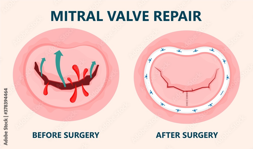 Fototapeta Cath Lab Atrial Septal Defect Tetralogy of Fallot Patent ...