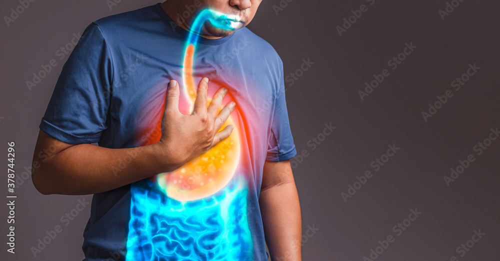gastroesophageal reflux disease (GERD)., x-ray concept. Stock Photo ...