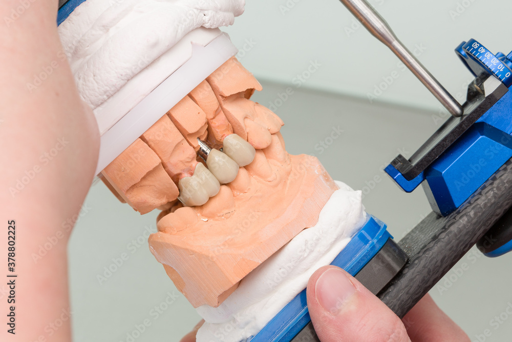 close up of quality control of a tooth implant on an articulator with a ...