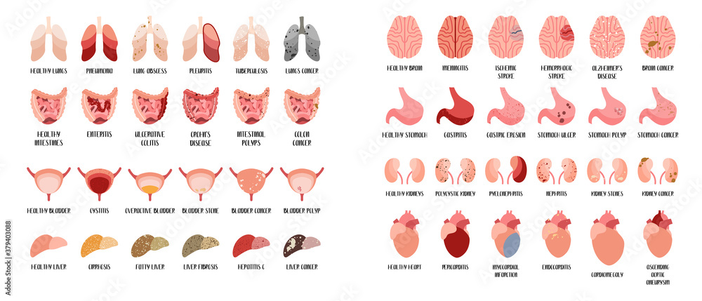 Plakát Healthy and unhealthy internal human organs – Obraz na Zeď ...