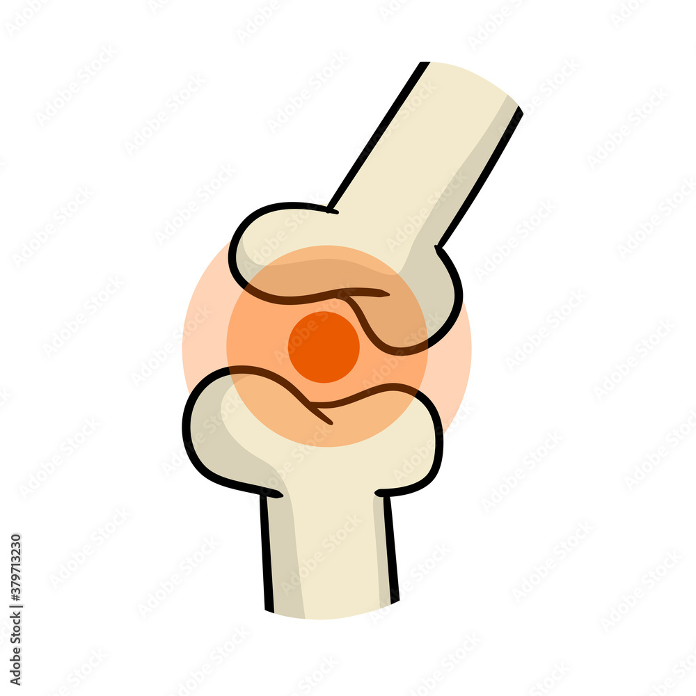Arthritis. Bones and interosseous cartilage. Biology and anatomy ...