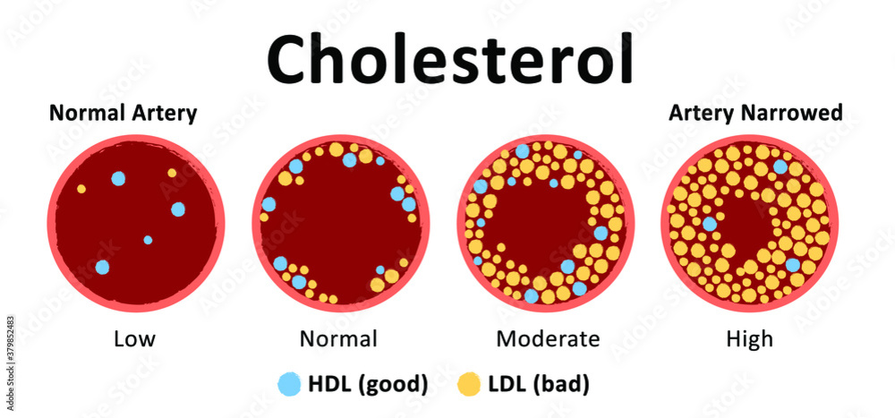High Cholesterol Arteries