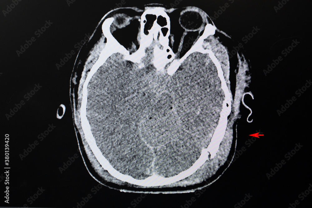 CT scan of skull fracture and cerebral hemorrhage Stock Photo | Adobe Stock