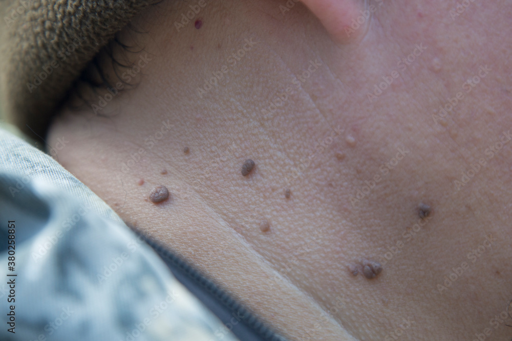 Papillomas on the human neck. Removal of papillomas. Stock Photo ...