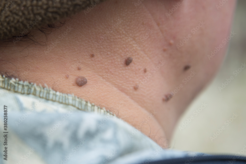 Papillomas on the human neck. Removal of papillomas. Stock Photo ...