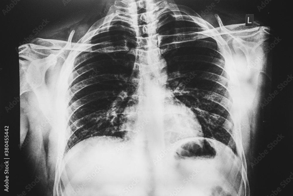 Chest/rib cage scan/x ray Stock Photo | Adobe Stock