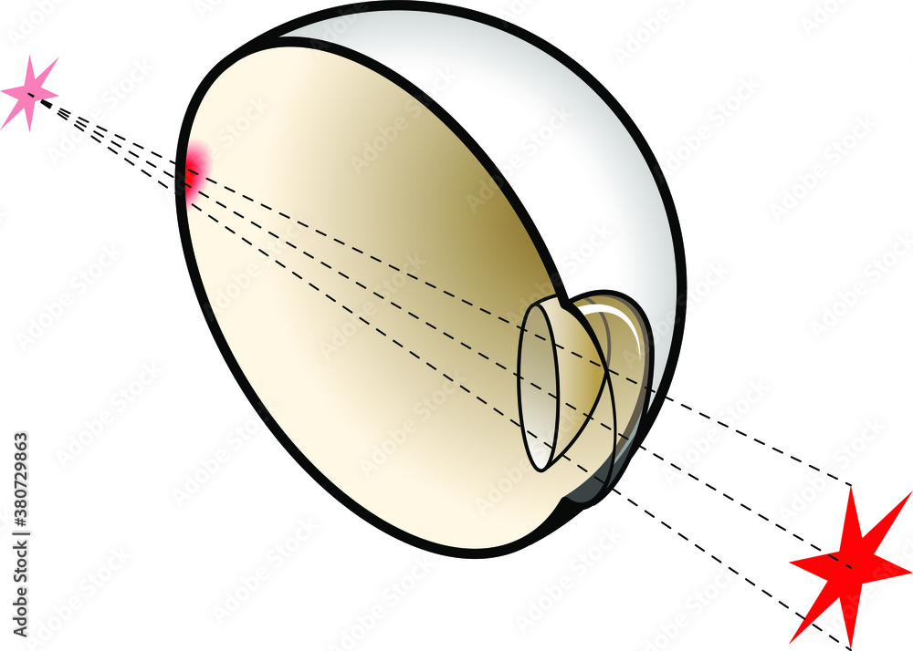 Cross section diagram of a long-sighted human eye. Stock Vector | Adobe ...