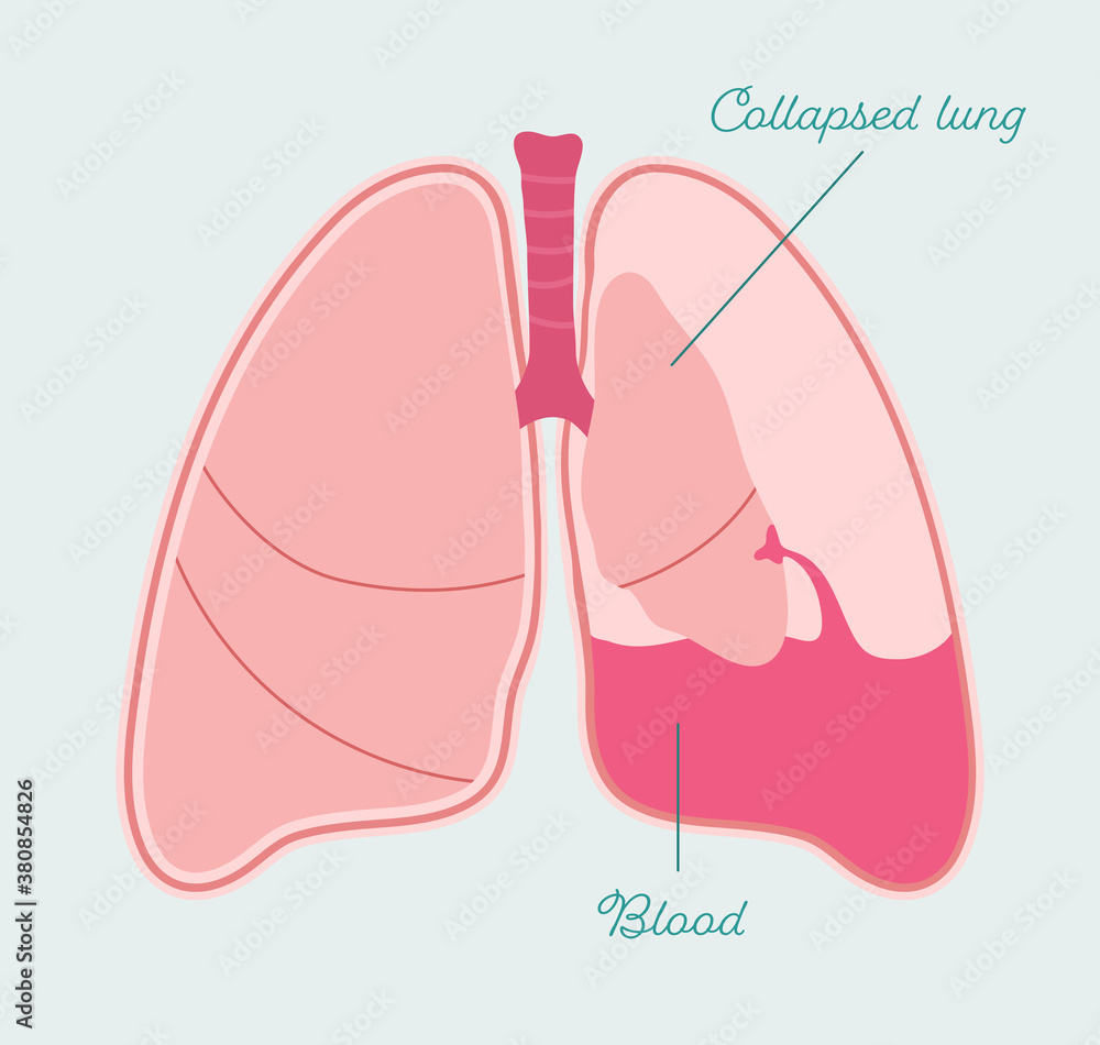 Anatomical scheme of Hemothorax. Bleeding human lung. Collectionof ...