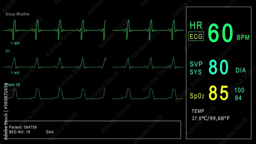 Looped: Patient monitor displays vital signs ECG electrocardiogram EKG ...