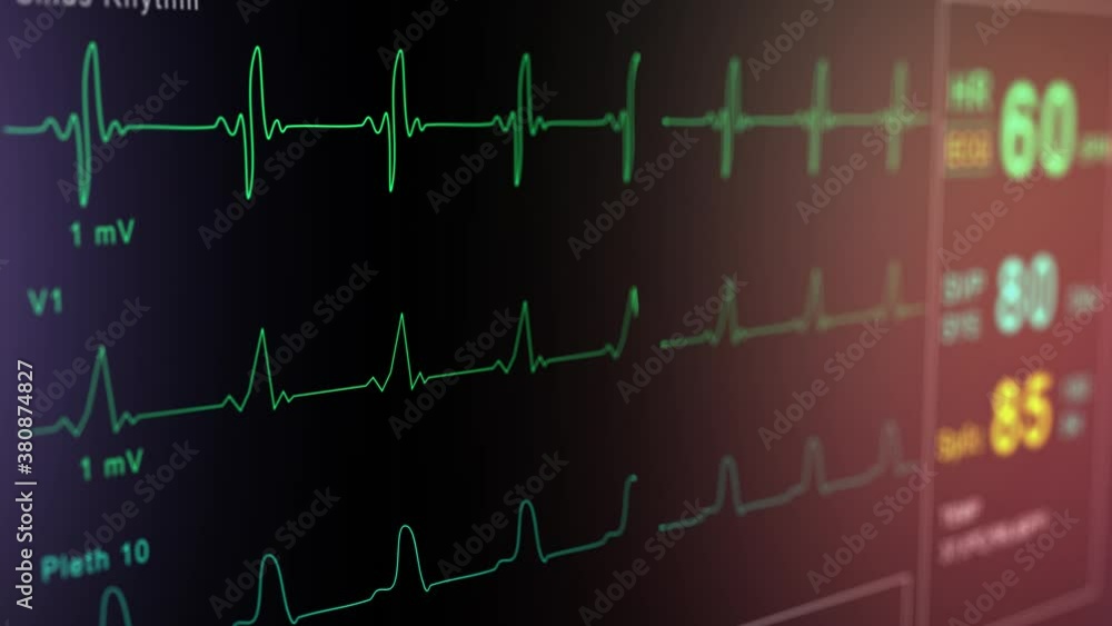 Patient monitor displays vital signs ECG electrocardiogram EKG, oxygen ...