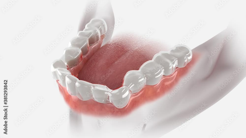 Teeth correction with transparent orthodontic retainer. 3D animation ...