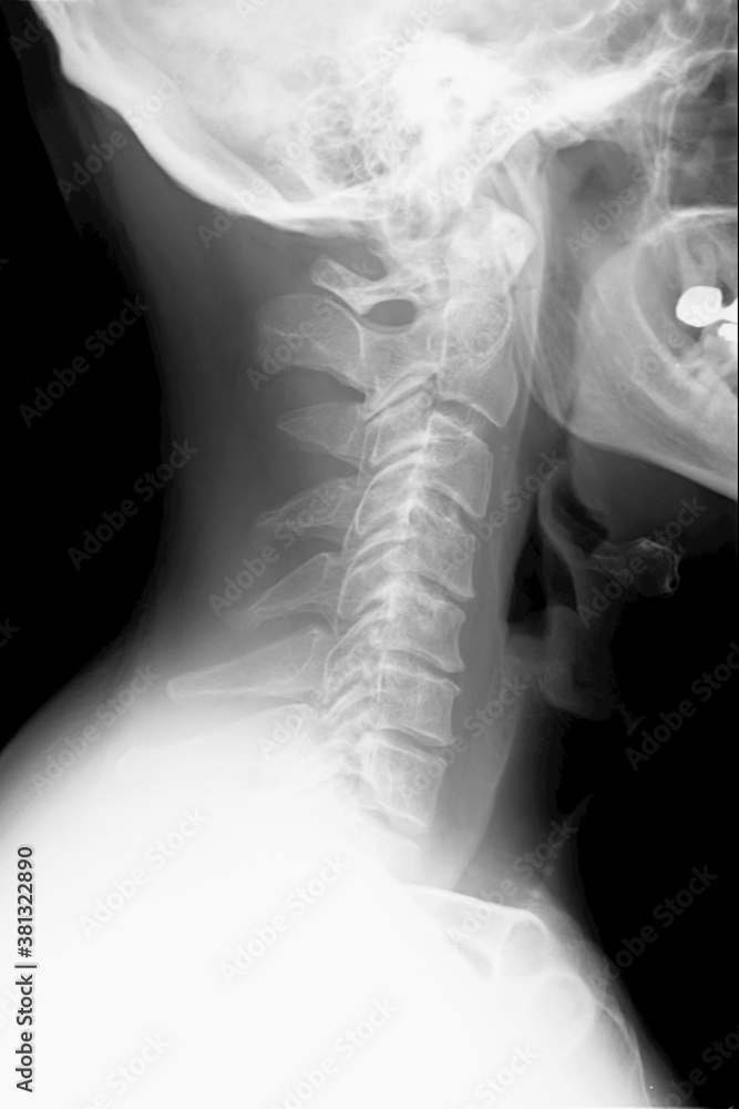 X-ray image of cervical, lateral view Stock Photo | Adobe Stock
