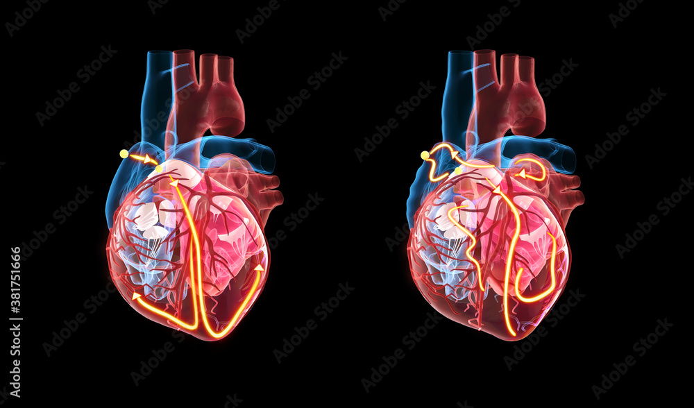 Anatomy of the human heart, the yellow lines demonstrating the ...
