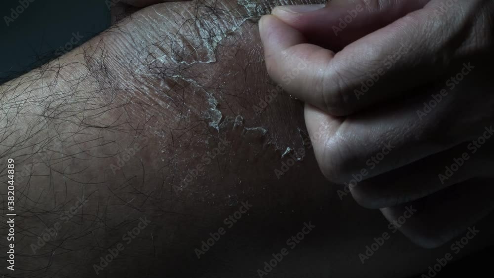 Peeling the skin on the knees,Skin disease Stock Video | Adobe Stock