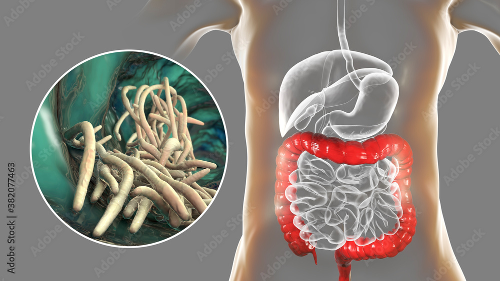 Parasitic worms in human large intestine Stock Illustration | Adobe Stock