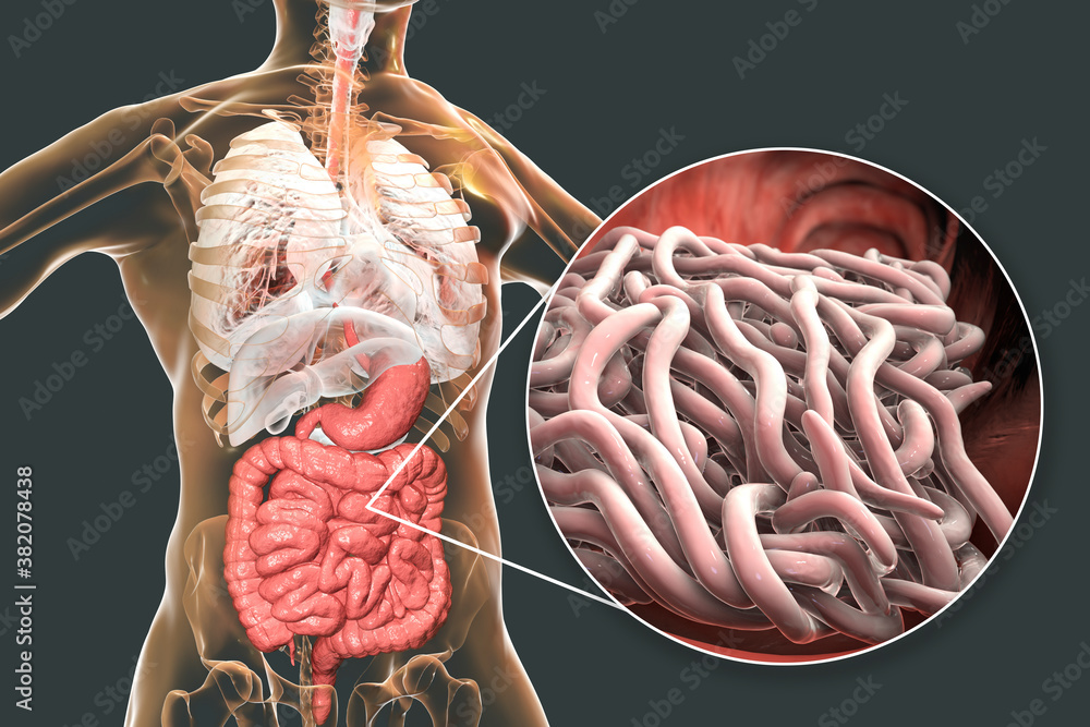 Parasitic worms in human intestine Stock Illustration | Adobe Stock
