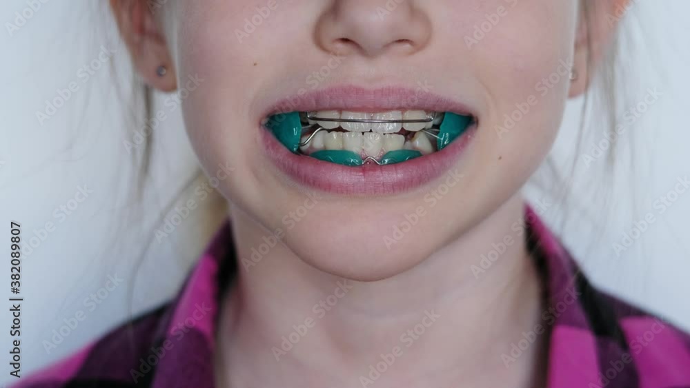 little / young smiling girl wears an orthodontic dental appliance ...