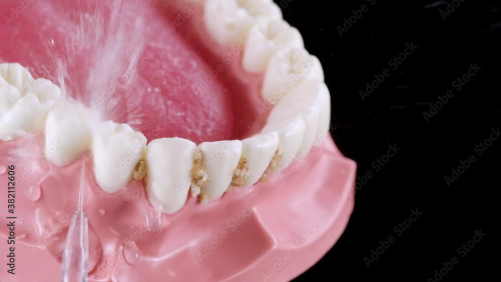 Fake jaw cleaning food remains with water flosser. Dirty teeth, corn ...