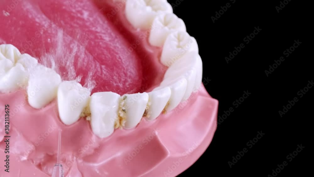 Fake jaw cleaning food remains with water flosser. Dirty teeth, corn ...