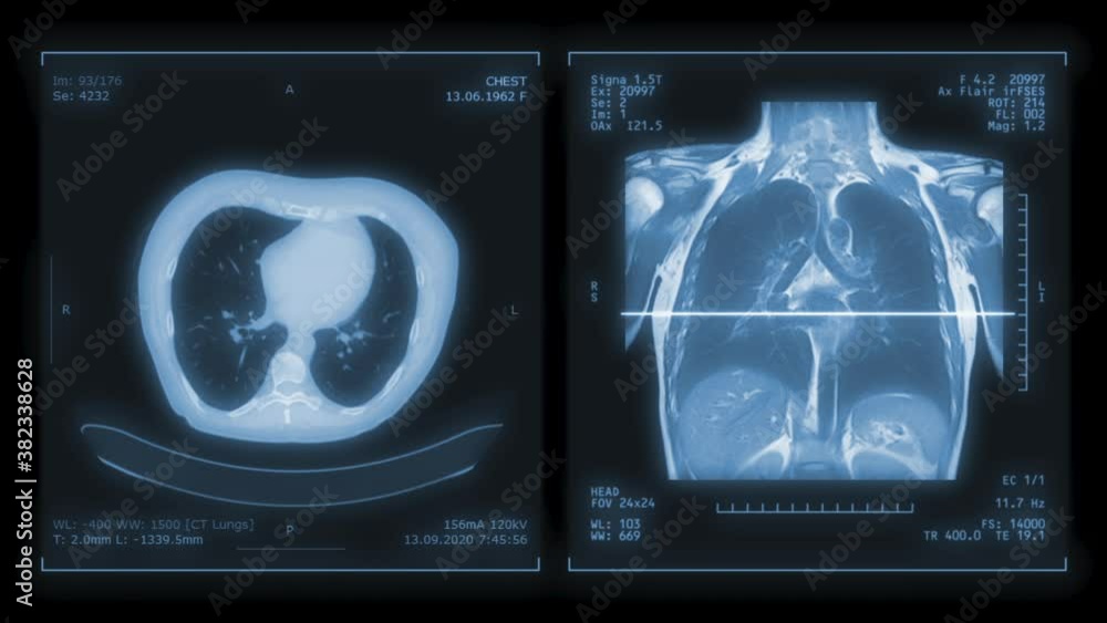 CT Chest or CT Scan of Human Chest Coronal MIP View with Lung filter technique for diagnosis TB ...