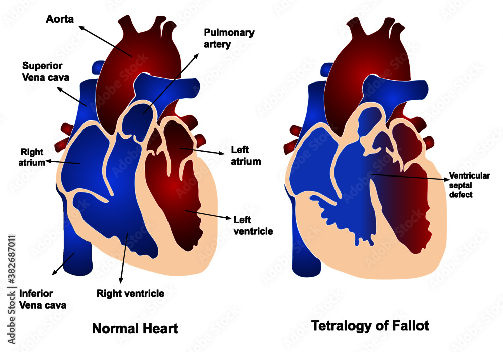 Congenital heart disease: Tetralogy of Fallot Stock Vector | Adobe Stock