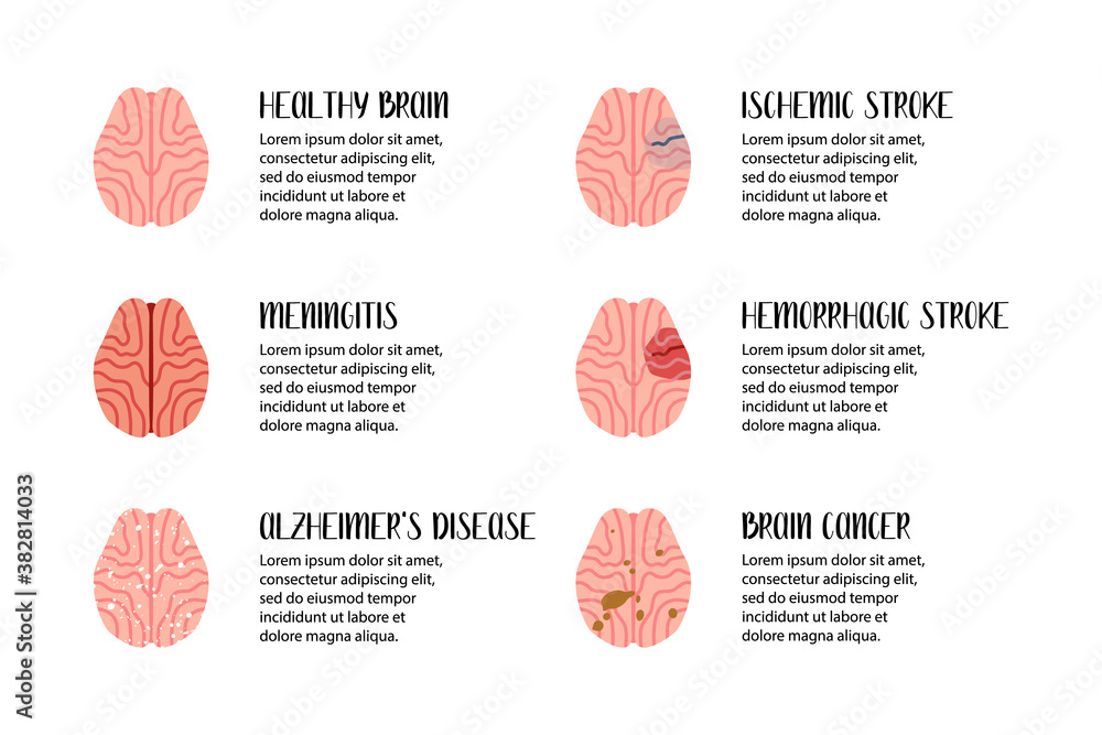 Brain diseases. Meningitis, ischemic and hemorrhagic stroke, alzheimer ...