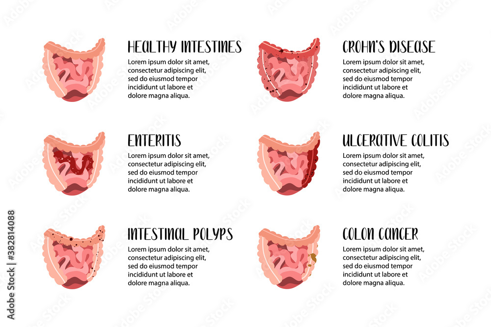 Intestines diseases. Enteritis, ulcerative colitis, Crohn's disease ...