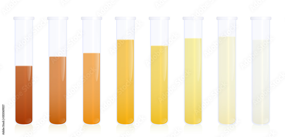 Urine samples, specimen test tubes with different colored urine ...