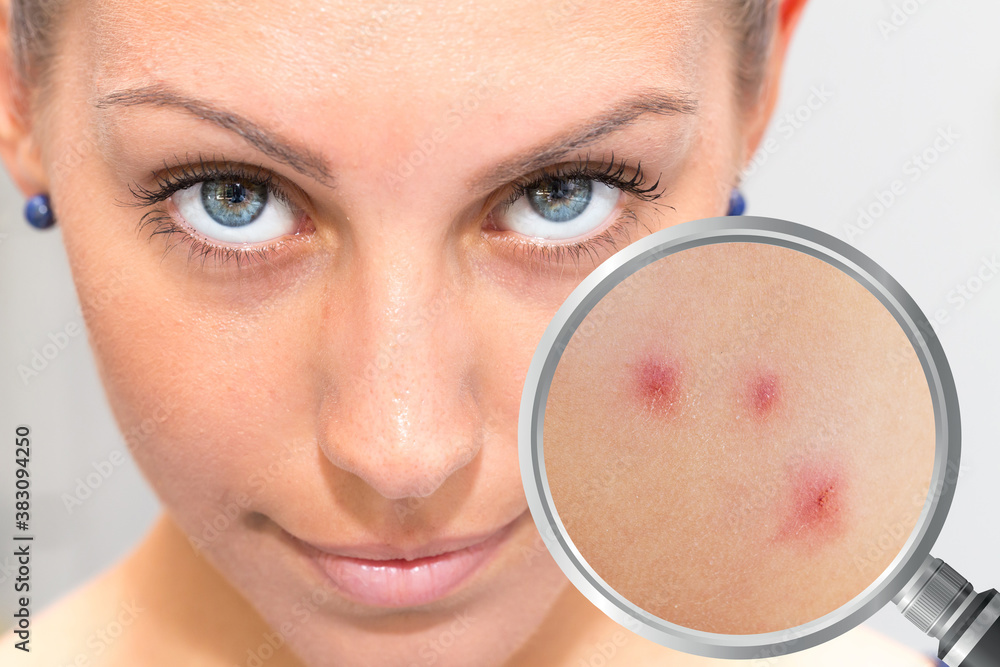 Face of girl with demodicosis. Lens magnification of a portion of skin ...