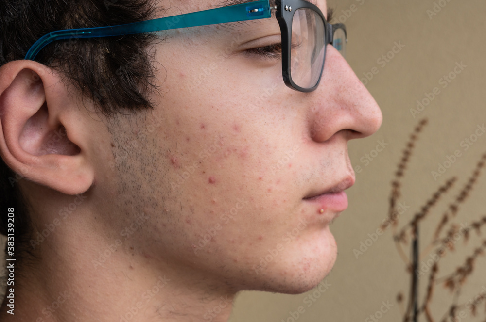 Close-up portrait on the skin of a young Caucasian boy in pubertal age ...