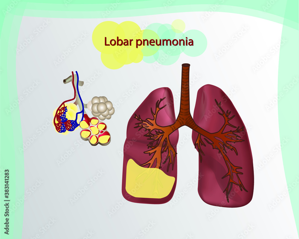 Lobar pneumonia. Vector graphics. The symbol of light. Alveoli. Cancer ...