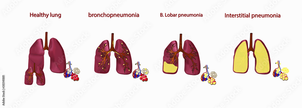 Medical educational biology map for lung diagram. Pneumonia. Vector ...