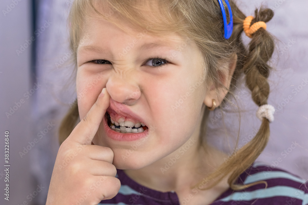 Adult permanent teeth coming in front of the child's baby teeth: shark ...
