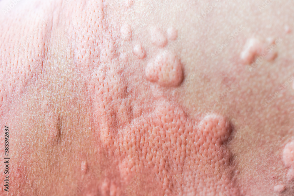 urticaria on skin. rashes, of which urticaria and toxic erythema are ...