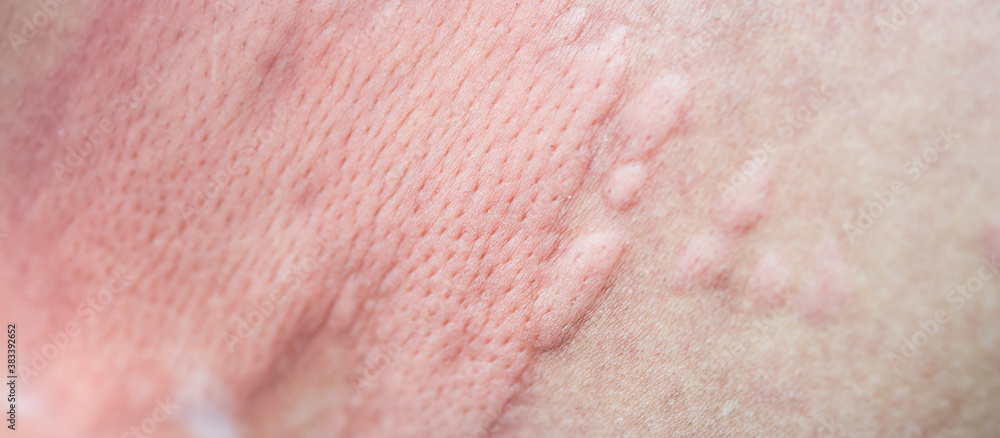 urticaria on skin. rashes, of which urticaria and toxic erythema are ...