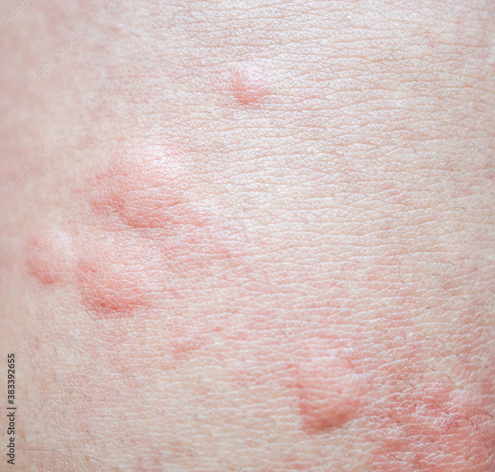 urticaria on skin. rashes, of which urticaria and toxic erythema are ...