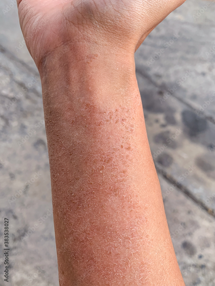 closeup dried rash of allergic contact dermatitis on forearm skin Stock ...