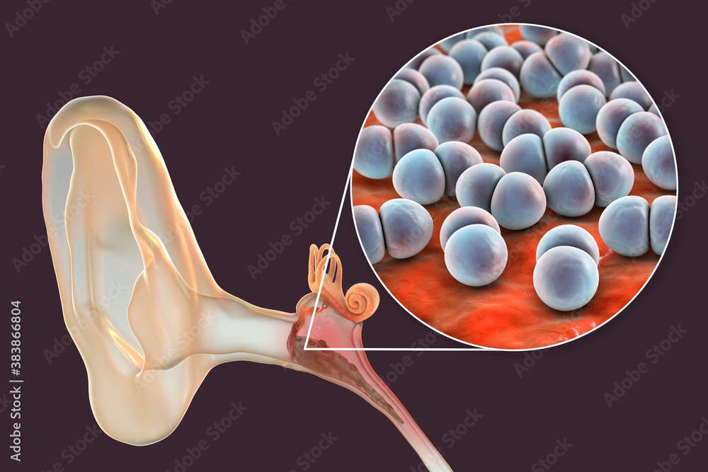 Otitis media, inflammatory disease of the middle ear Stock Illustration ...