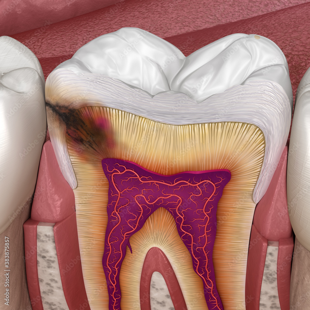 Hidden caries in to molar tooth. Medically accurate 3D illustration ...