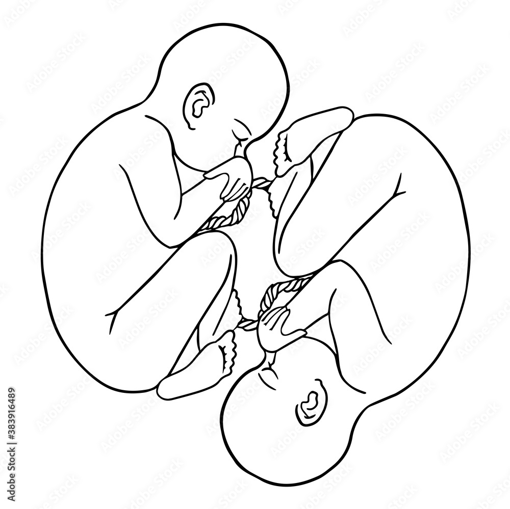 Human twins fetus prenatal growing baby, umbilicle cord as an obstetric ...