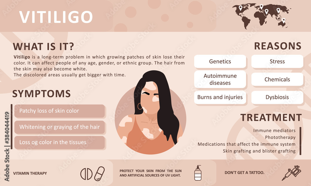 Infographics of vitiligo. Causes of the disease. Abstract woman ...