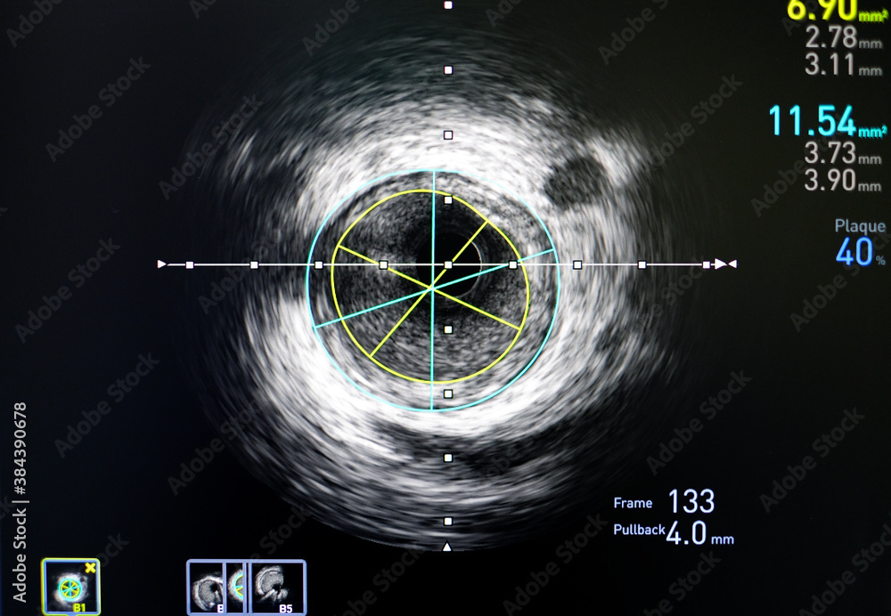 Foto de Intravascular ultrasound imaging (IVUS) for assessment inside coronary artery, cardiac ...