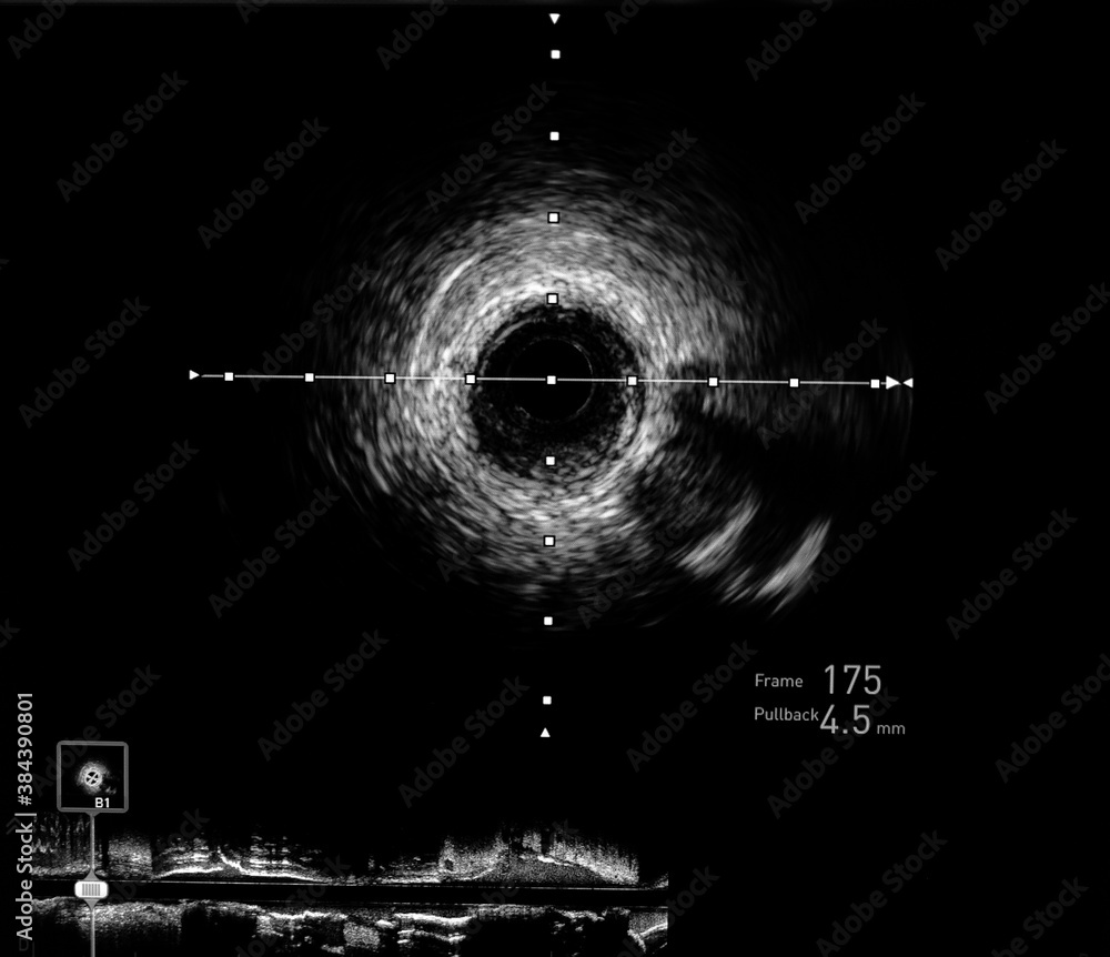 Intravascular ultrasound imaging (IVUS) for assessment inside coronary ...