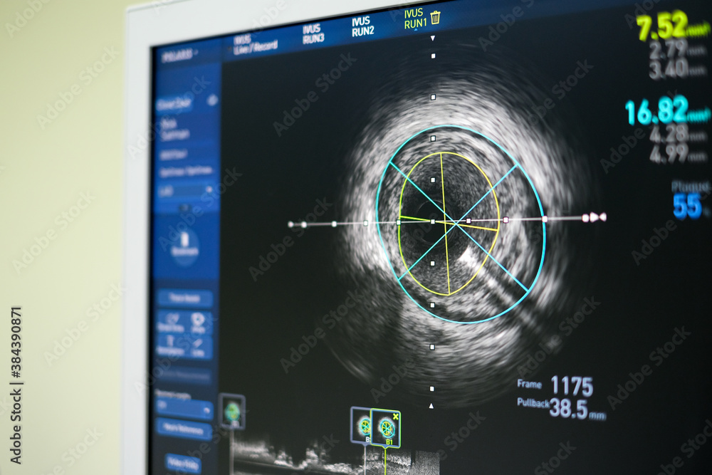 Intravascular ultrasound imaging (IVUS) for assessment inside coronary ...
