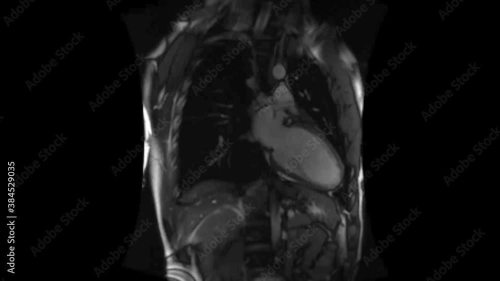human heart mri in real time, heartbeat, frontal Stock ビデオ | Adobe Stock