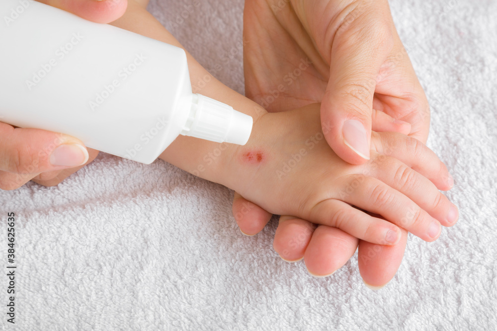 Young woman hand holding white bottle of hydrogen peroxide and pouring ...