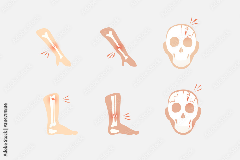 Broken bones, set of illustrations. Arms and legs with internal ...