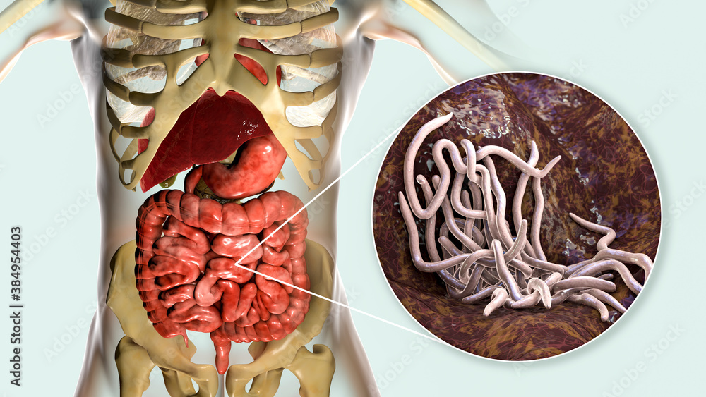 Parasitic worms in human small intestine Stock Illustration | Adobe Stock